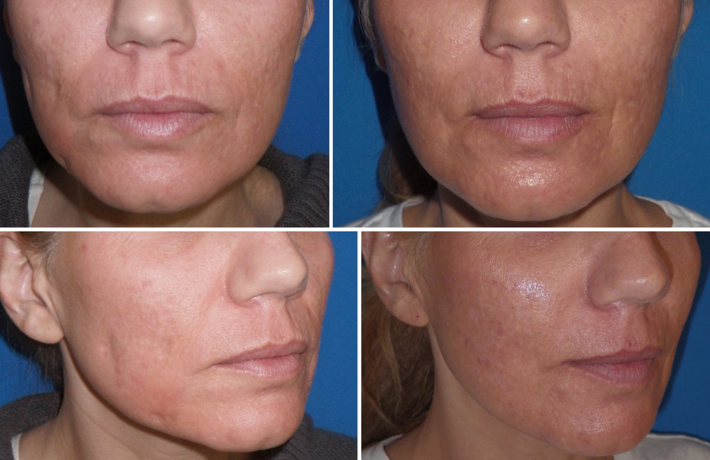 Facial Scars & Keloids Richmond VA | Keloid Scar Treatment