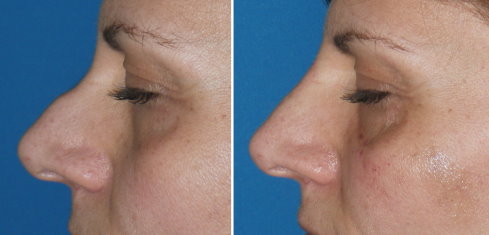 Fillers Midface Richmond VA | Filler Augmentation of Cheeks