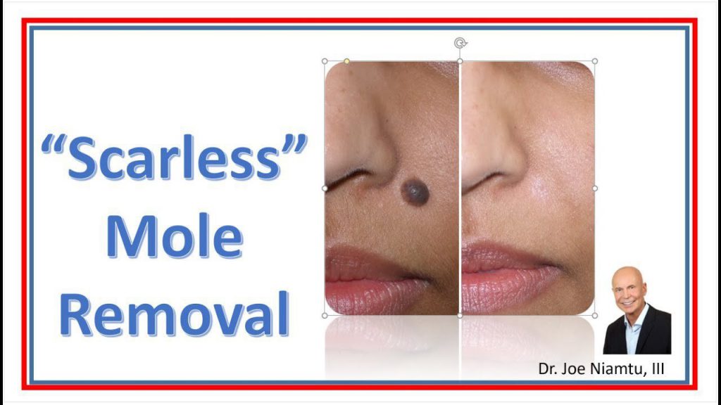 Mole Removal Richmond VA | Removal of Mole | Remove Mole Midlothian