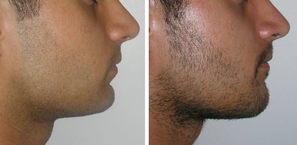 Genioplasty Richmond VA | Chin Implant | Chin Augmentation Midlothian