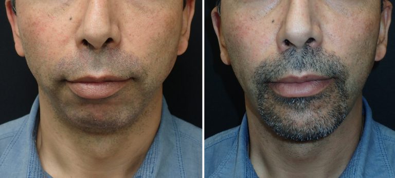 Genioplasty Richmond VA | Chin Implant | Chin Augmentation Midlothian