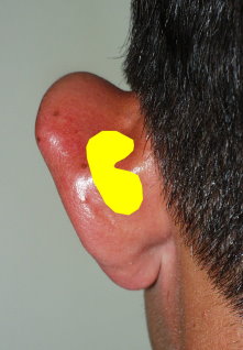 Otoplasty: Pinning Back Protruding Ears