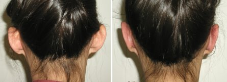 Otoplasty: Pinning Back Protruding Ears