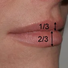 Lip Reduction:Sometimes Needles are Not Enough