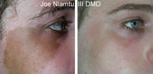 Bullying and Cosmetic Surgery in Children