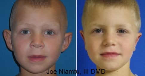 Bullying and Cosmetic Surgery in Children