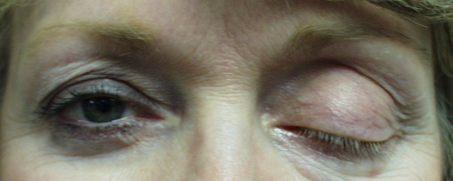 Doctor; the Botox made my eyelids Droop!