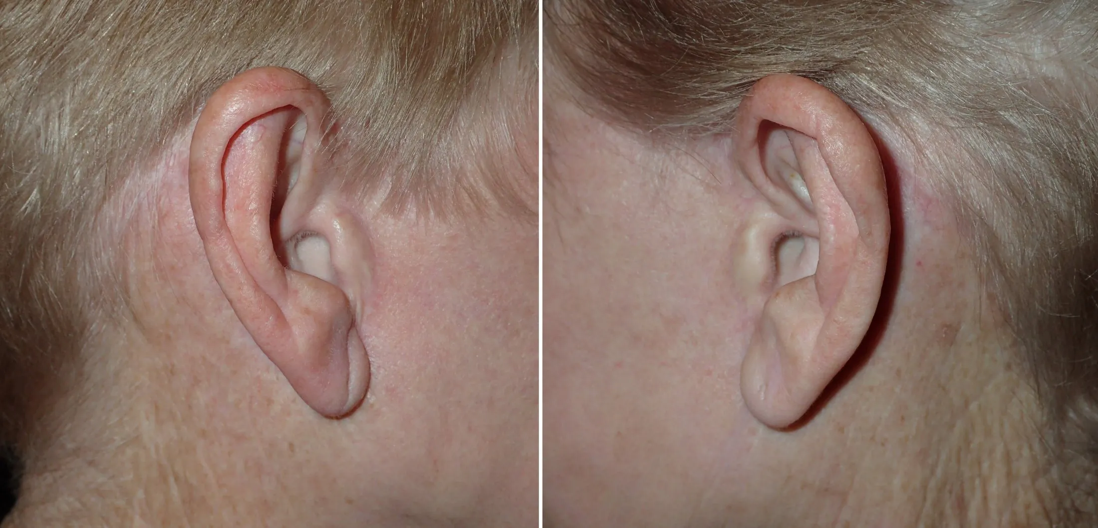 Facelift Incisions & Scars Richmond VA | Hidden Facelift Scars