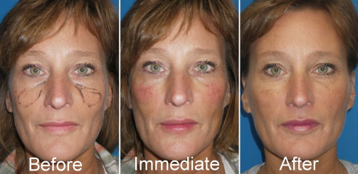 Fillers Midface Richmond VA | Filler Augmentation of Cheeks