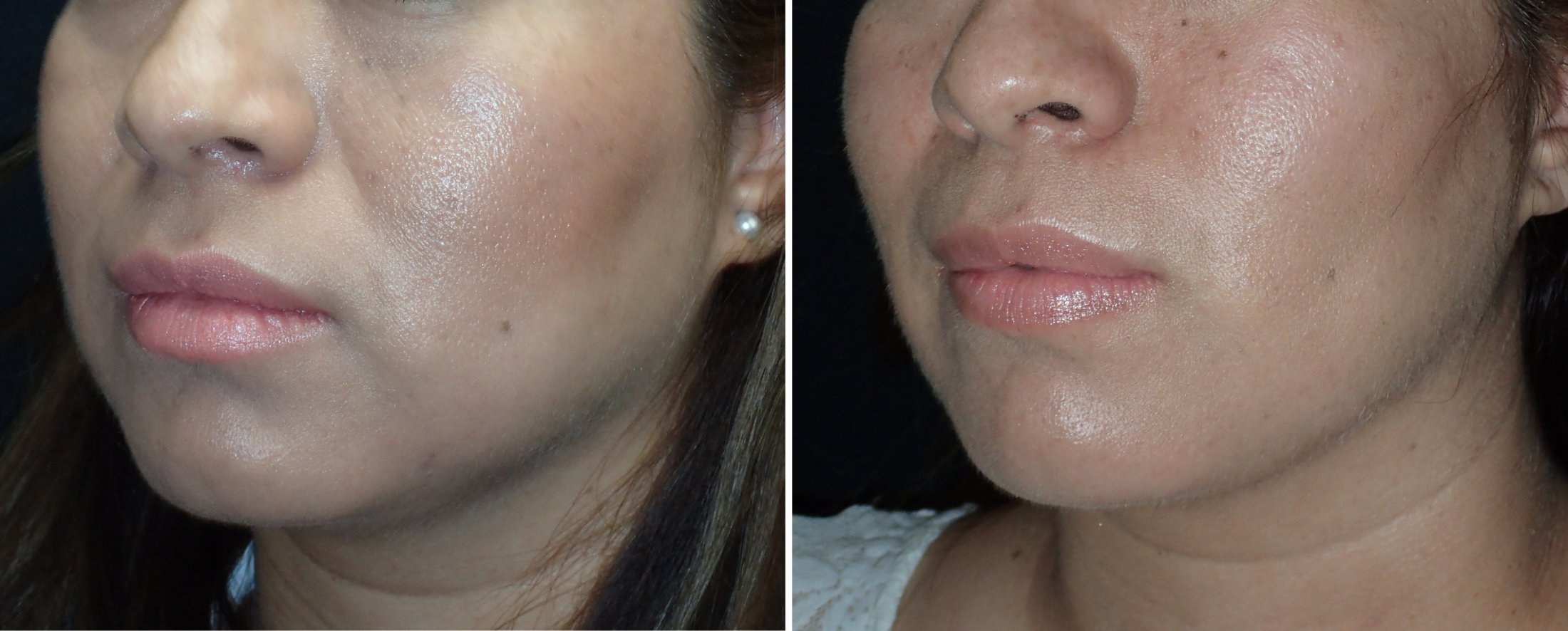 Buccal Fat Pad Reduction Richmond VA | Midface Procedure