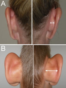 Otoplasty | Fix Protruding Ears Richmond VA | Ear Surgery