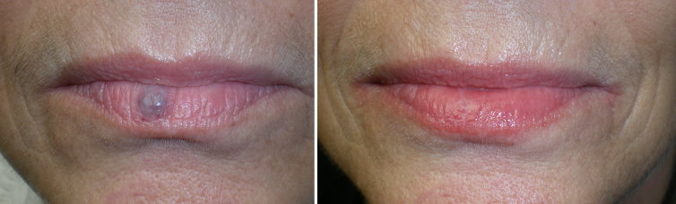 Birthmarks Treatment with Vascular Laser Richmond VA | Laser Treatment