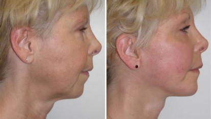 Mini Facelift Gallery Richmond VA | Niamtu Cosmetic Facial Surgery