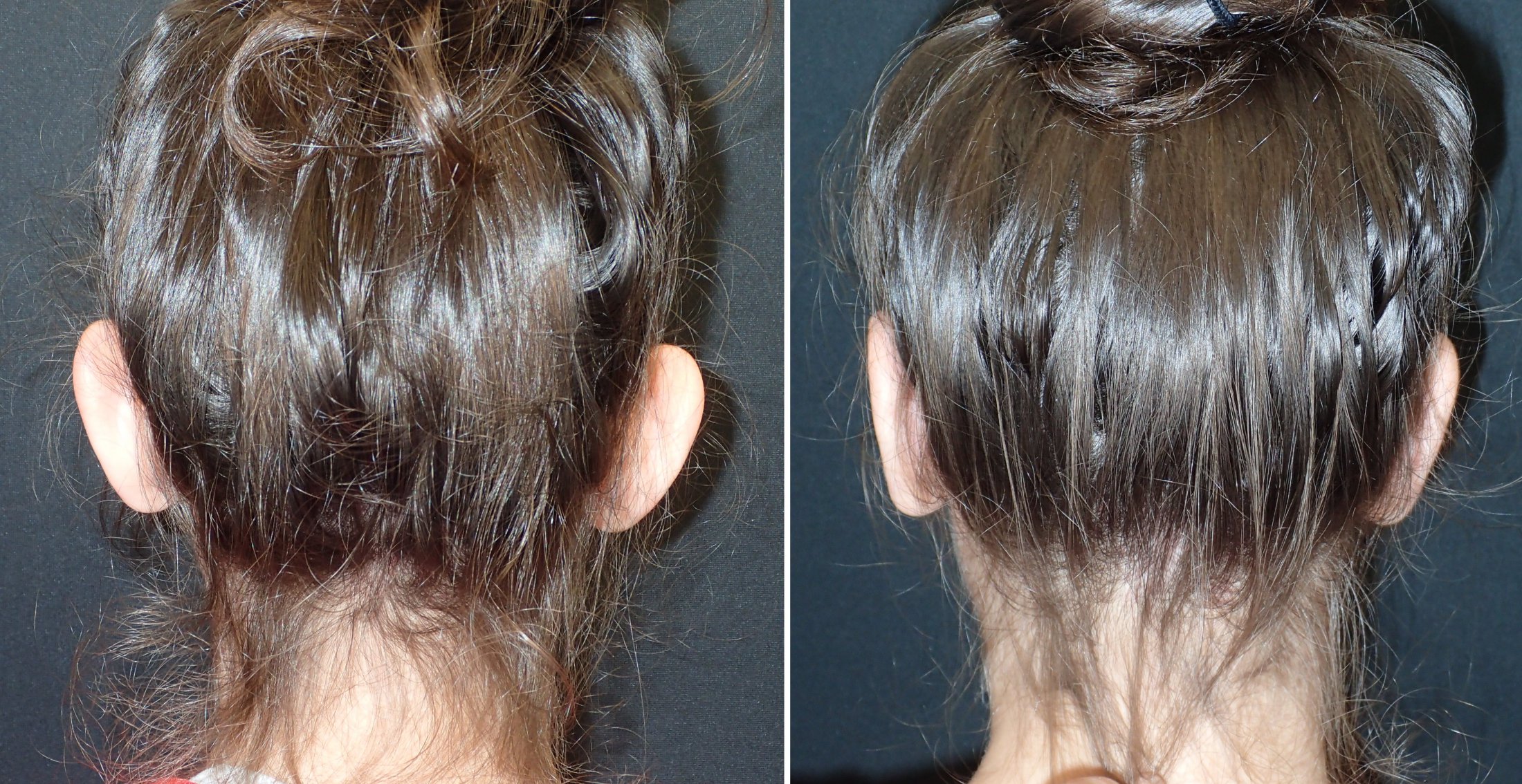 Otoplasty | Fix Protruding Ears Richmond VA | Ear Surgery