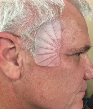 Facial Implants for Men Richmond VA | Facial Cosmetic Surgery for Men