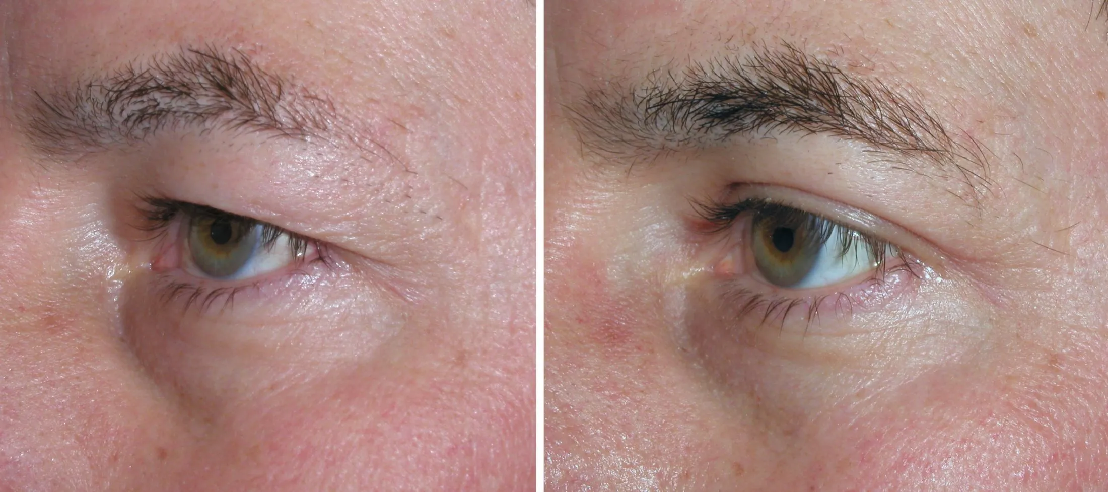 Eyelid Surgery for Men Richmond | Blepharoplasty for Men