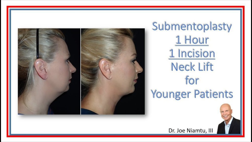 1 Incision 1 Hour Neck Lift Submentoplasty For Younger Patients