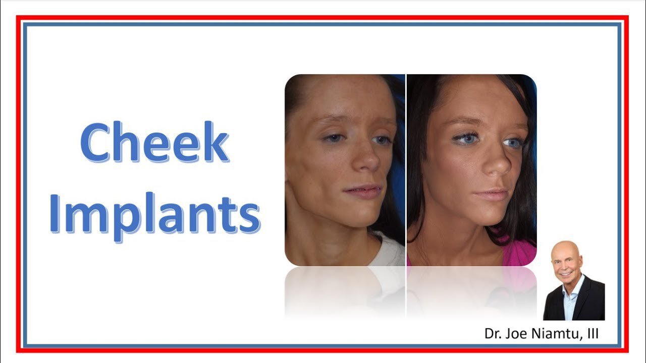 Cheek Implants Richmond VA | Facial Fillers | Midface Implants