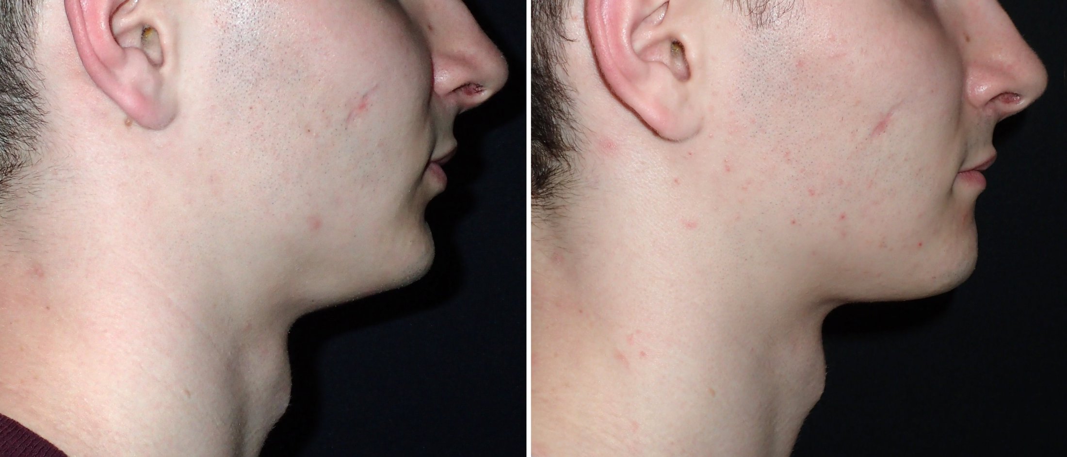 Day 3 Chin Implant And Lipo : r/PlasticSurgery