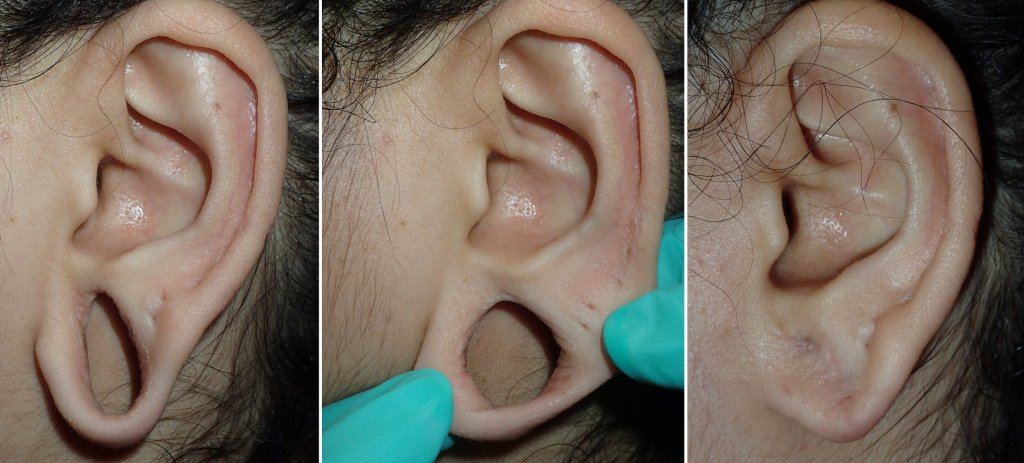 Gauged Earlobe Repair Richmond VA | Repair Earlobe Midlothian
