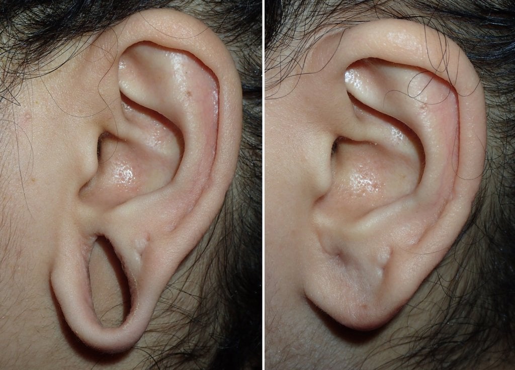Gauged Earlobe Repair Richmond VA | Repair Earlobe Midlothian
