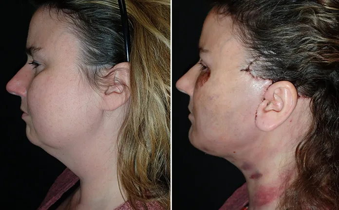 Face And Neck Lift Recovery What A Difference A Day Makes