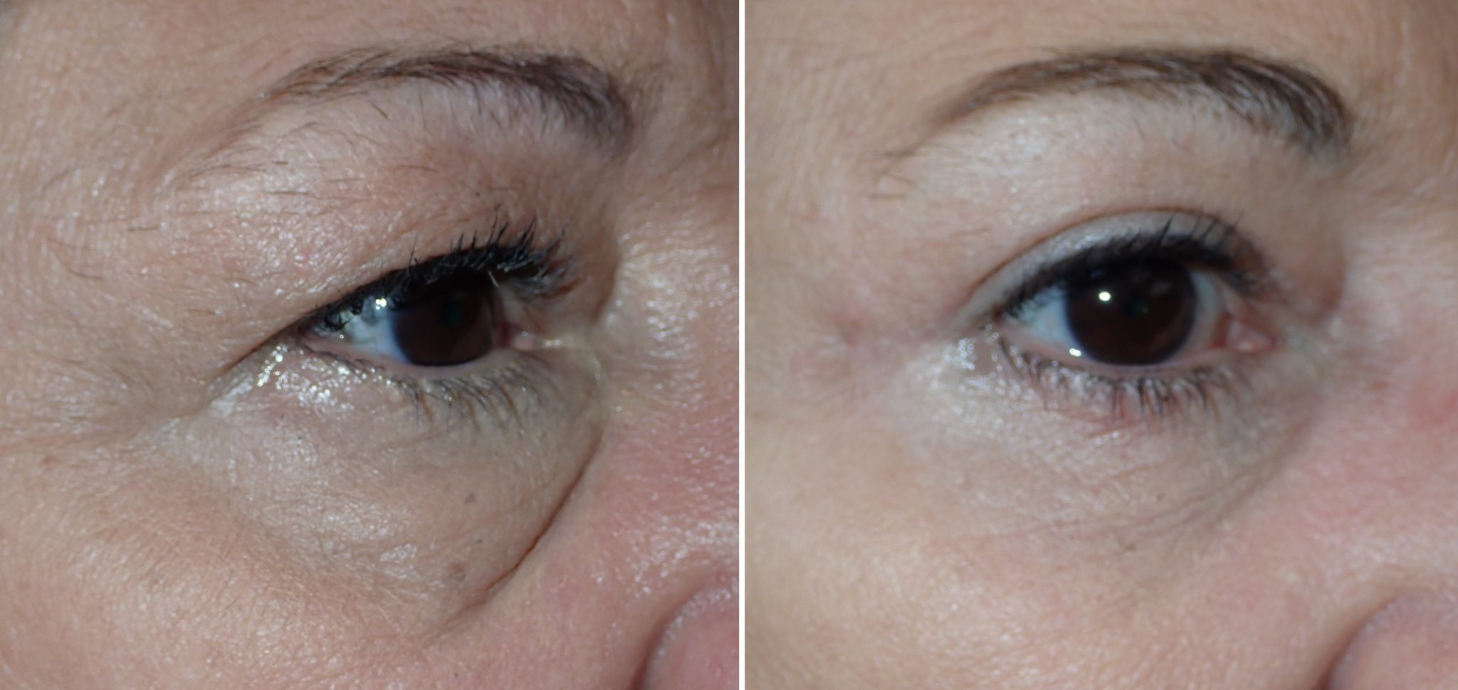 Today's Great Little Case: Upper & Lower Eyelid Laser Blepharoplasty ...