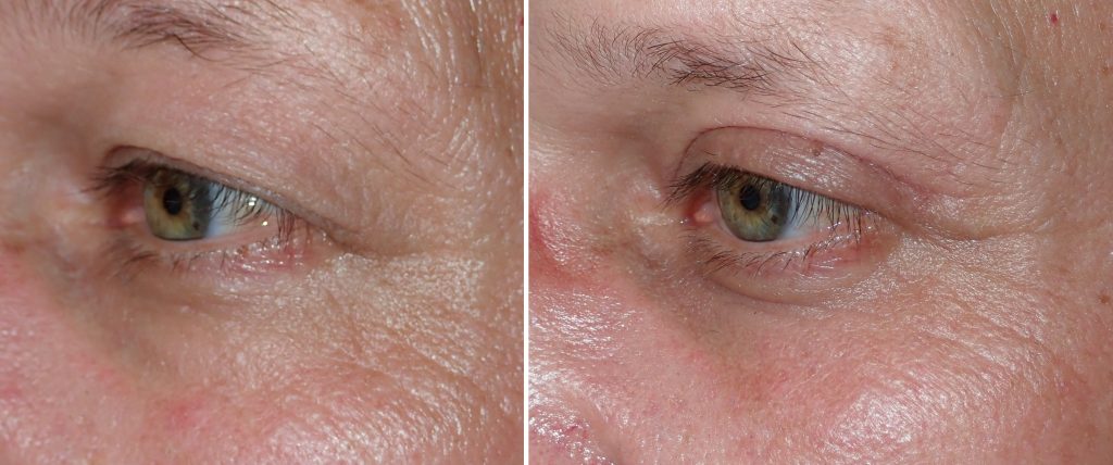 30 Minute Surgical Procedure can Reverse Decades of Aging