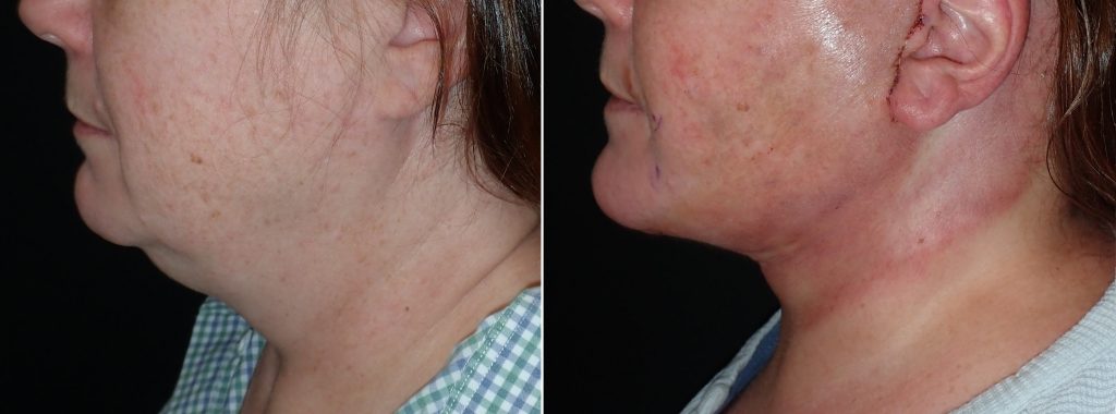 More 24 Hour Facelift Results