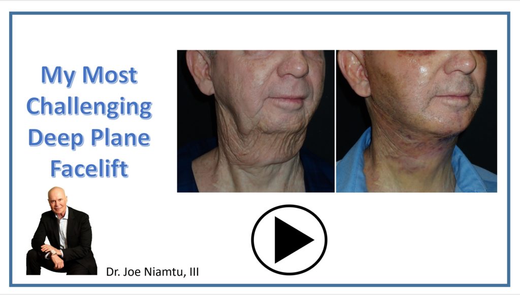 Challenging Deep Plane Facelift