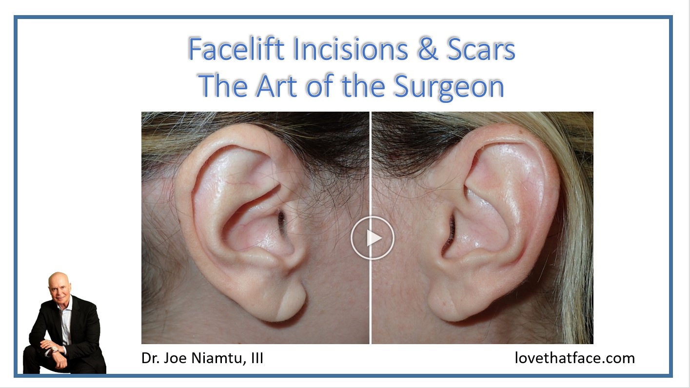 Facelift Incisions & Scars: Watch this if you are considering a facelift