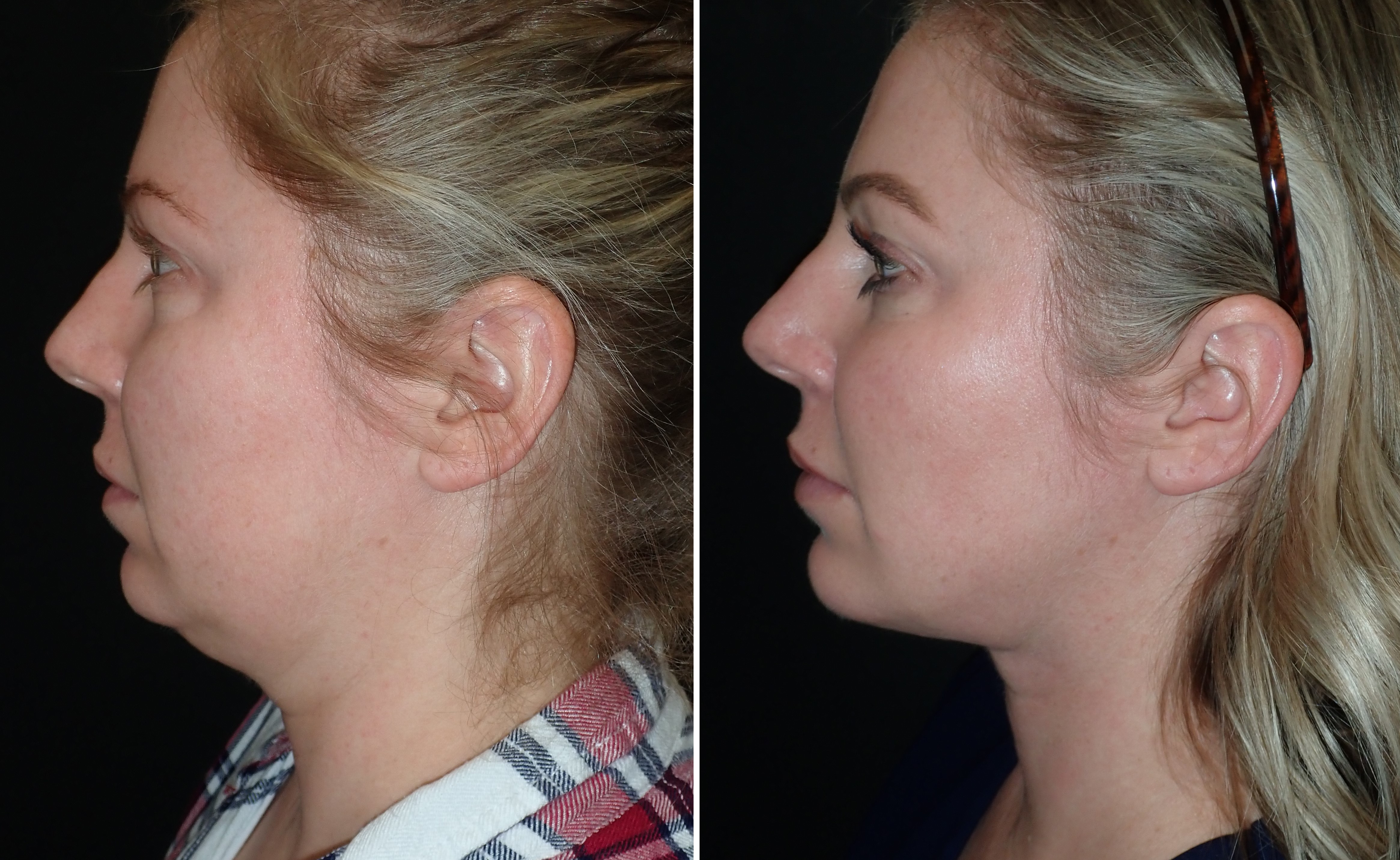 Submentoplasty Richmond VA | Chin & Neck Lift | Neck Rejuvenation