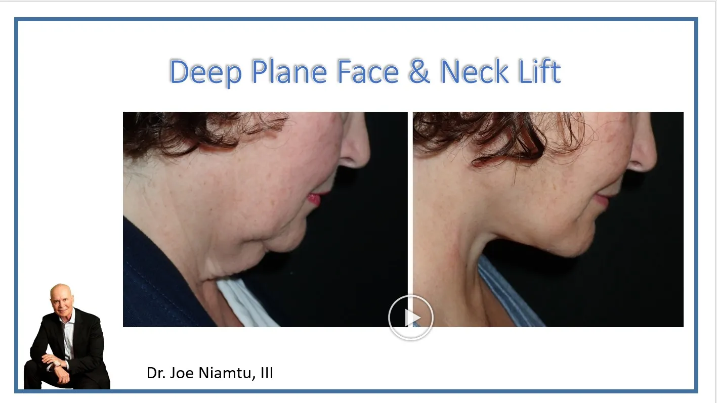 Deep Plane Facelift with Deep Plane Neck Lift and Submandibular Gland ...
