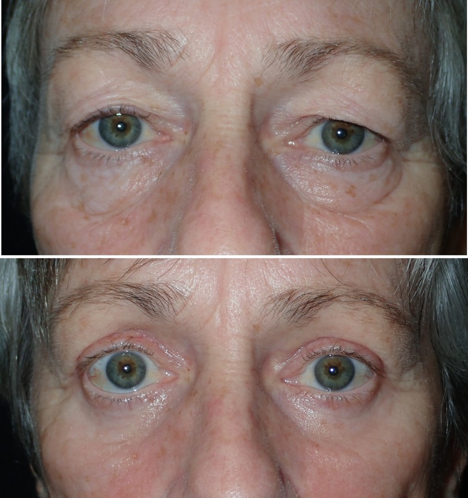 Eyelid Surgery Richmond VA | Blepharoplasty Surgery | Eyelid Tuck