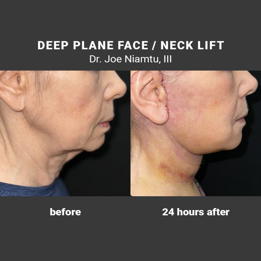 Deep Plane Facelift Richmond VA
