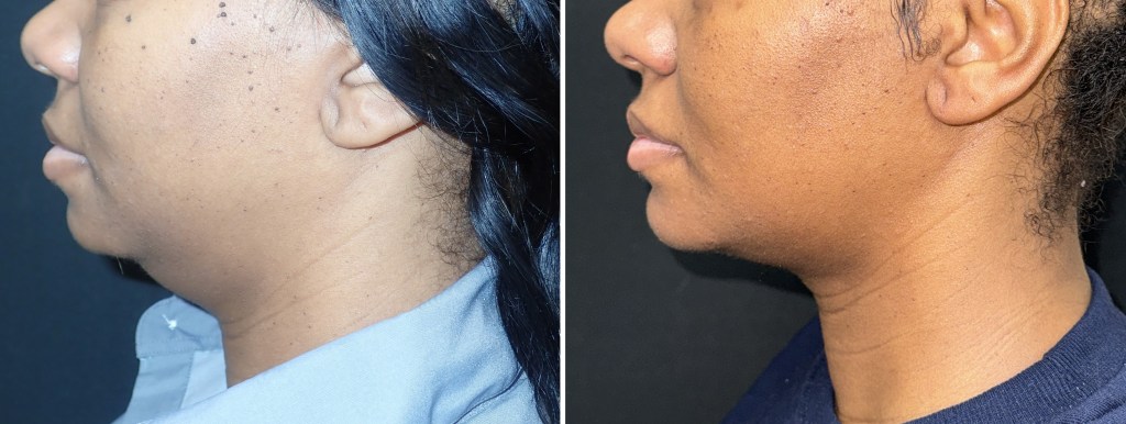 Submentoplasty Richmond VA | Chin & Neck Lift | Neck Rejuvenation