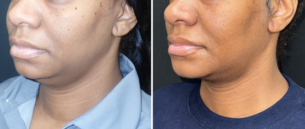Submentoplasty Richmond VA | Chin & Neck Lift | Neck Rejuvenation
